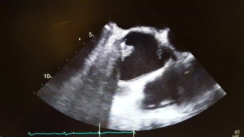 Echocardiogram Showing Vegetation On Pacemaker Wire Stock Footage Video ...
