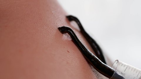 Doctor Putting Leech On Patient Neck Stock Footage Video (100% Royalty ...