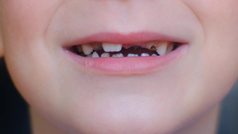 Rotten teeth child Stock Video Footage - 4K and HD Video Clips ...