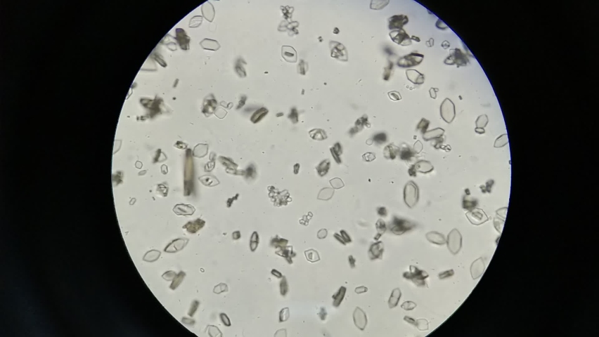 Uric Acid Crystals Stock Video Footage - 4K and HD Video Clips ...