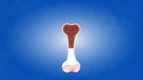 Graphic Animation Development Human Bone Osteoporosis Stock Footage ...