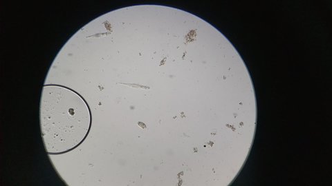 Schistosoma Haematobium Parasite Human Urine Specimen Stock Footage ...