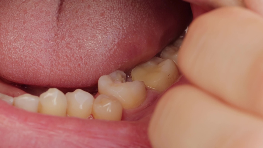 Deep Caries in the Patients Stock Footage Video (100% Royalty-free ...