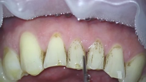 Dentistry Microscope Photography Elimination Dental Plaque Stock ...