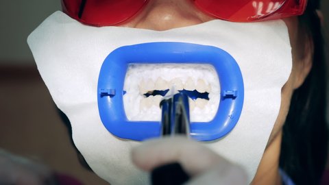 Dental Bleaching Procedure Performed On Patient Stock Footage Video ...