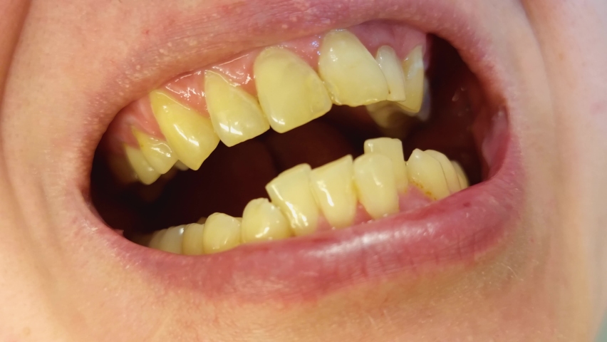 showing off crooked yellow teeth caucasian Stock Footage Video (100% ...