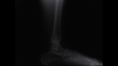 1950s Xray Person Walking Man Slowly Stock Footage Video (100% Royalty ...