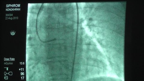 Cardiac Catheterization Procedure That Uses Wire Stock Footage Video ...
