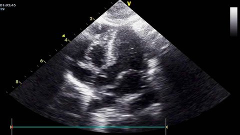 Echocardiography Showing 5 Chamber Apical View Stock Footage Video (100 ...
