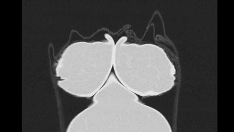 Coronal View Computed Tomography Ct High Stock Footage Video (100% ...