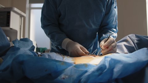 Team Surgeons Stitches Patients Body Needle Stock Footage Video (100% ...