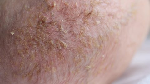 Removing Seborrheic Dandruff Flakes Crusts Off Stock Footage Video (100 ...