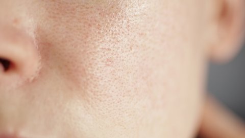 Skin Texture Unhealthy Enlarged Pores Rosacea Stock Footage Video (100% ...