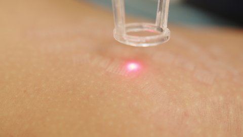 Co2 Laser Resurfacing Treatment Belly Abdominal Stock Footage Video ...