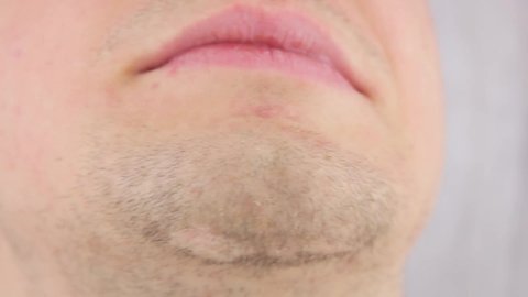 Scar On Mans Chin Scar On Stock Footage Video (100% Royalty-free ...