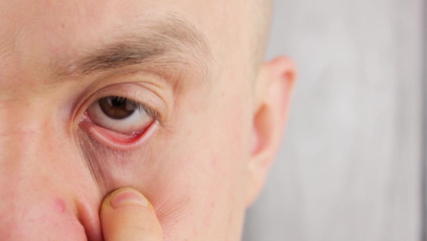 pull eyelid down vision eye examination Stock Footage Video (100% ...