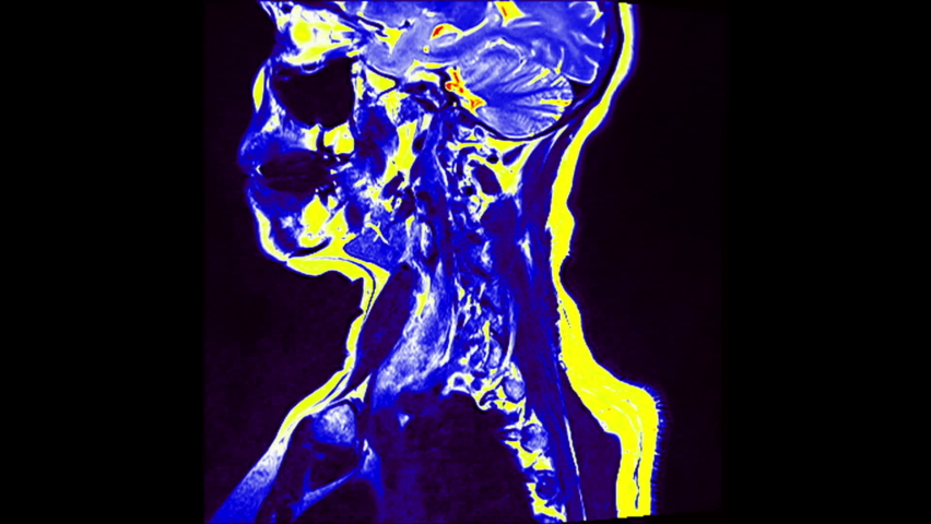 Mri Magnetic Resonance Imaging Cervical Spine Stock Footage Video (100% ...
