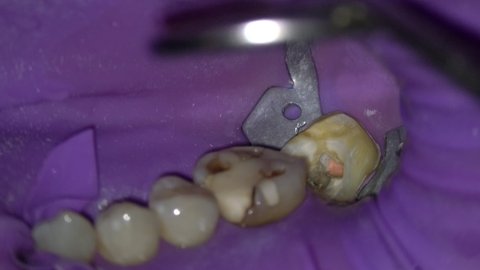 Tooth Bonding Build Crown On Molar Stock Footage Video (100% Royalty ...