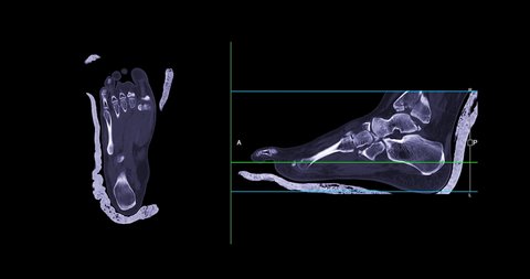 Ct Scan Foot Coronal Sagittal View Stock Footage Video (100% Royalty ...