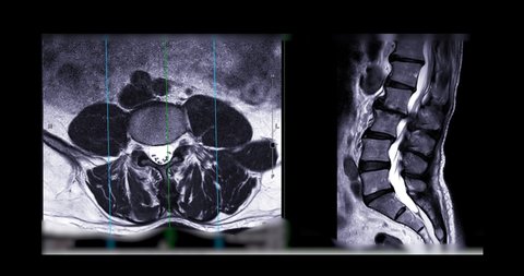 Mri Ls Spine Lumbar Spine Axial Stock Footage Video (100% Royalty-free ...