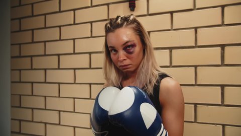 Young Blonde Girl Black Eye After Stock Footage Video (100% Royalty ...