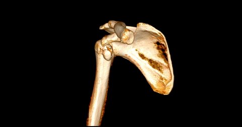 Ct Scan Shoulder Joint 3d Rendering Stock Footage Video (100% Royalty ...