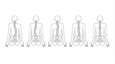 This Animated Video Various Scoliosis Stock Footage Video (100% Royalty ...