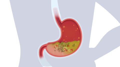 Gastric Problem Waste Food Stomach Digestive Stock Footage Video (100% ...