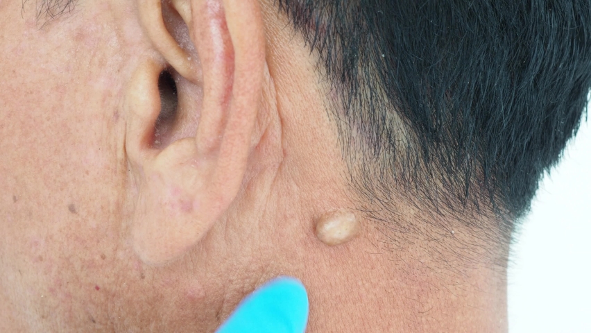 Sebaceous Cyst Footage Videos And Clips In Hd And 4k