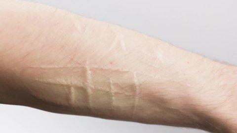 Scars Cuts On Arm Suicide Marks Stock Footage Video (100% Royalty-free ...