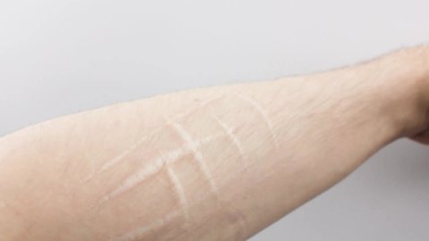 Scars Cuts On Arm Suicide Marks Stock Footage Video (100% Royalty-free ...