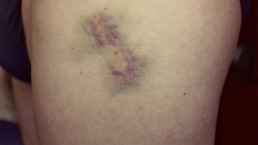 BRUISE-ON-HAND Footage, Videos and Clips in HD and 4K - Avopix.com