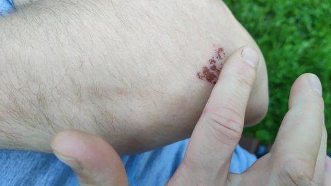 Abrasion On Elbow Man Strokes Scratch Stock Footage Video (100% Royalty ...