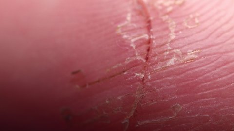 Deep Cut On Fingertip Healing Forming Stock Footage Video (100% Royalty ...