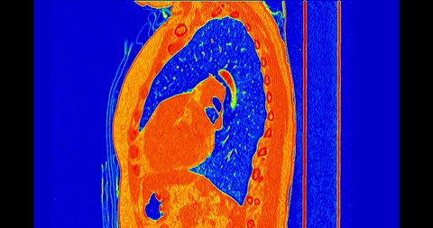 Ct Scan Chest Ct Lung 3d Stock Footage Video (100% Royalty-free ...