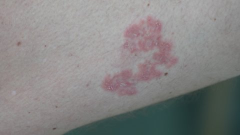 Closeup Man Touching Red Rash On Stock Footage Video (100% Royalty-free ...