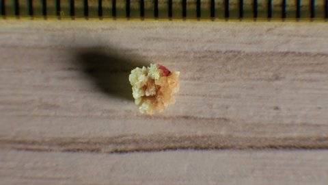 Oxalate Kidney Stone 4 Mm Stone Stock Footage Video (100% Royalty-free ...