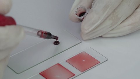 Dropping Blood Pipette Onto Slide Glasses Stock Footage Video (100% ...