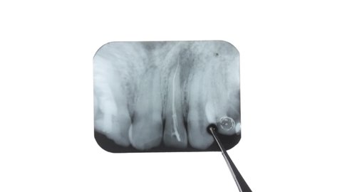 Cyst Xray Tooth Radicular Cyst Upper Stock Footage Video (100% Royalty ...