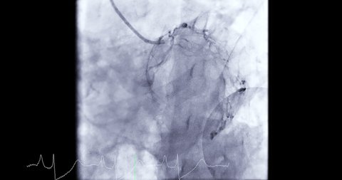 Coronary Angiogram Coronary Artery During Cardiac Stock Footage Video ...