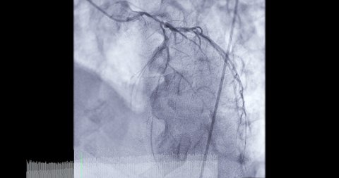 Coronary Angiogram Coronary Artery During Cardiac Stock Footage Video ...