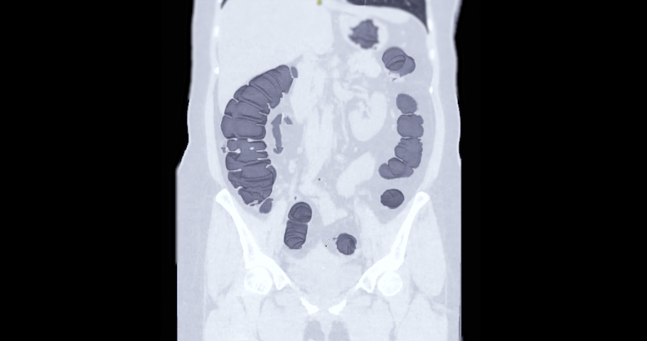 LARGE-INTESTINE-COMPUTER Footage, Videos and Clips in HD and 4K ...