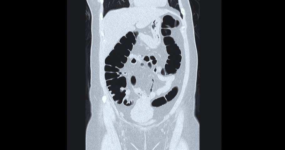 LARGE-INTESTINE-COMPUTER Footage, Videos and Clips in HD and 4K ...