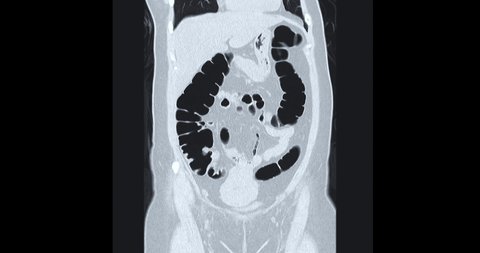 Ct Colonography Ct Scan Large Intestine Stock Footage Video (100% ...