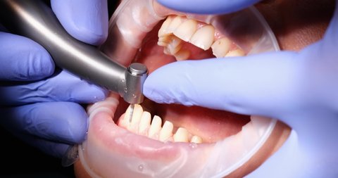 Dentist Prepares Female Teeth Removes Tooth Stock Footage Video (100% ...