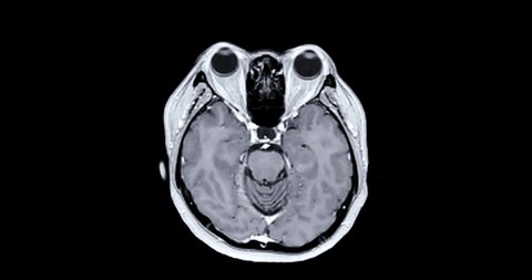 Mri Brain Axial T1 Fs Technique Stock Footage Video (100% Royalty-free ...