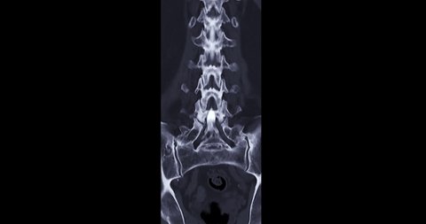 Ct Lumbar Spine Myelography Myelogram Computed Stock Footage Video (100 ...