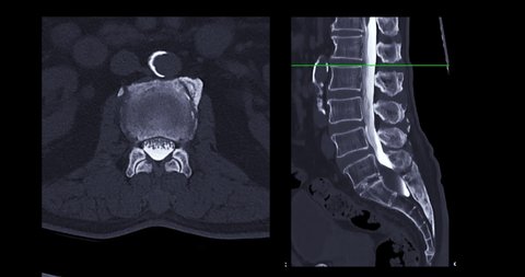 Ct Lumbar Spine Myelography Myelogram Computed Stock Footage Video (100 ...