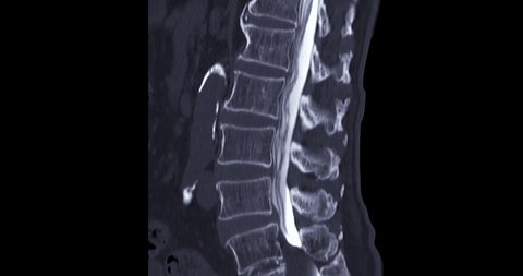 Ct Lumbar Spine Myelography Myelogram Computed Stock Footage Video (100 ...