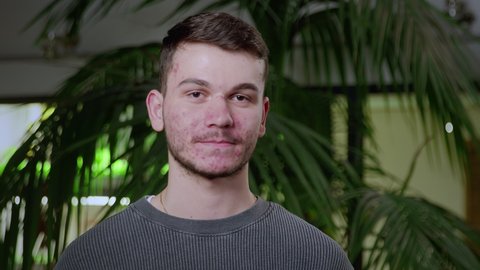 Closeup Young Man Pimples On His Stock Footage Video (100% Royalty-free ...